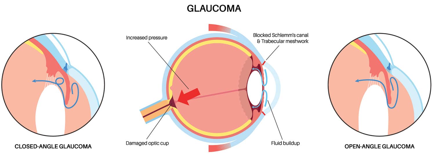Glaucoma Classifications | Harvard Eye Associates