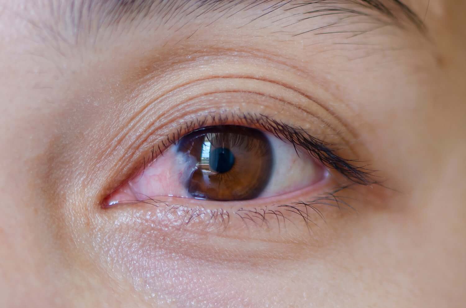 Pterygium Orange County | Pterygium Removal Orange County